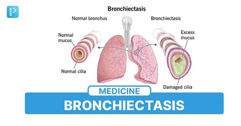 Bronchiectasis Causes Pathophysiology Clinical Features