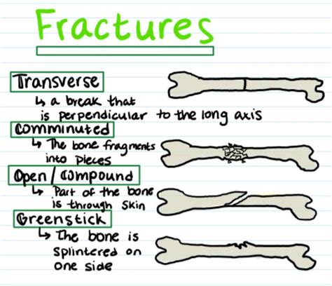 Fracture Types Nursing Babe Motivation Medical Babe Stuff Medical Babe Inspiration