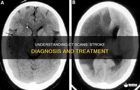 Understanding Ct Scans Stroke Diagnosis And Treatment Medshun Understanding Ct Scans Stroke Diagnosis And Treatment Medshun