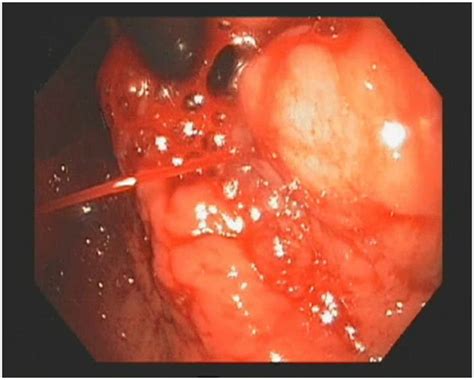 Endoscopic View Of Fundal Varix Gastroesophageal Varices Type 1 With