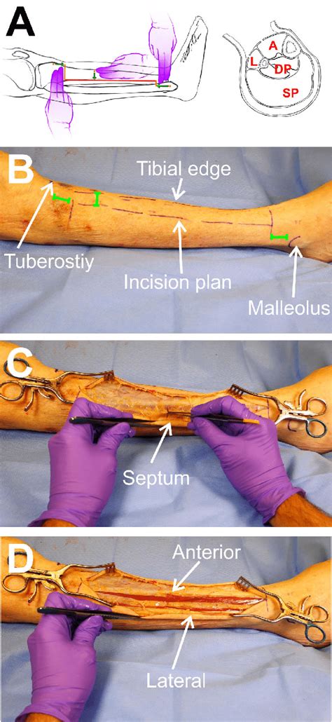 Diagrammatic And Cadaveric Demonstration Of The New Incision Placement Download Scientific