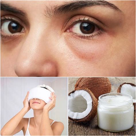 Home Remedies For Reducing Puffy Eyes From Allergies