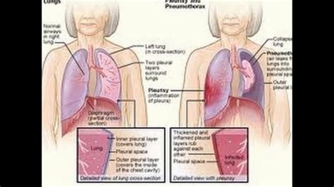 Can Pleurisy Cause Lung Scarring Symptoms Treatment Causes And Recovery Time