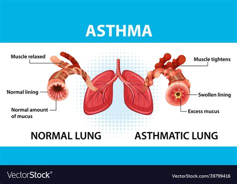 Bronchial Asthma Diagram With Normal Lung Vector Image