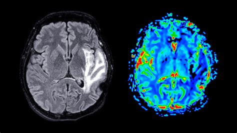 Brain Features In Living Athletes Linked To Cte Risk Nyu Langone