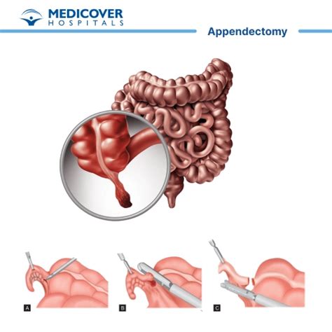 Apendicectomía Tipos Procedimientos Riesgos Y Recuperación