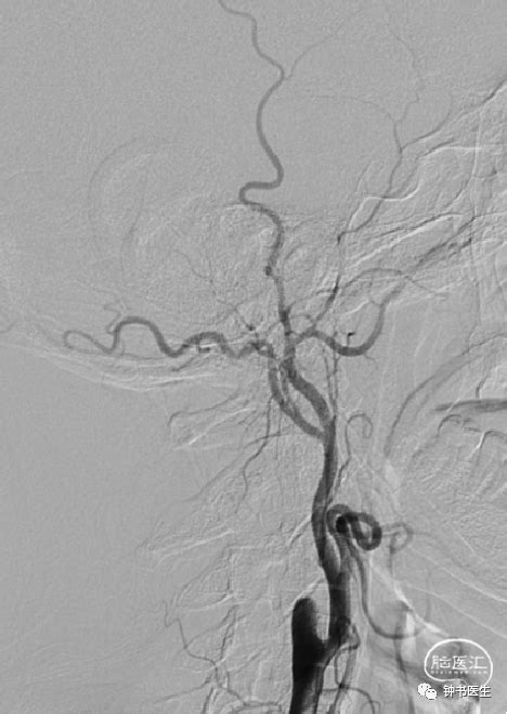 中枢介入第356期：源自后交通动脉动脉瘤出血 双微导管长圈技术栓塞 脑医汇