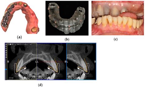 Fiducial Marker Protocol Of Implant Planning A An Occlusal Image Of Download Scientific