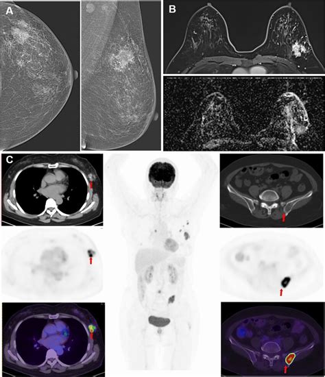 55y Female Left Invasive Ductal Breast Cancer With Microcalcification Download Scientific