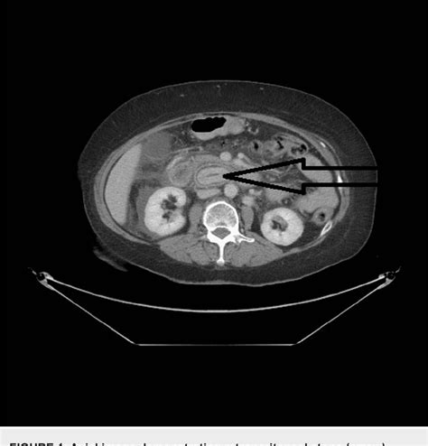 Figure 1 From A Case Of Perforated Duodenal Diverticular Stone Semantic Scholar