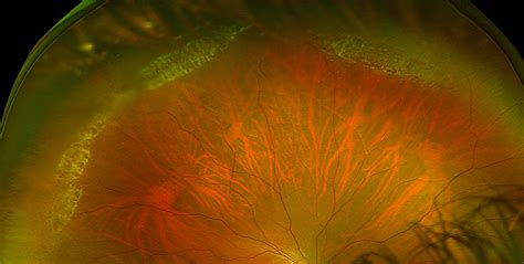 Sonoran Desert Eye Center Snailtrack Lattice Degeneration