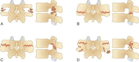 Pseudarthrosis Clinical Tree