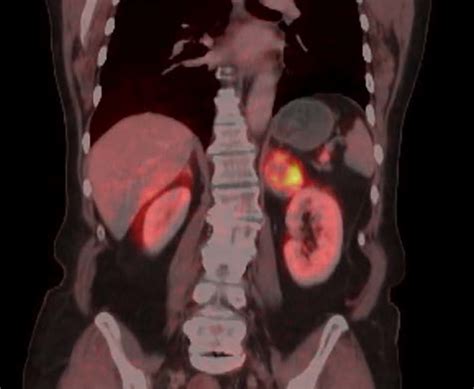 Combined Dopa Petct Scan Of The Abdomen Showing An Intensively