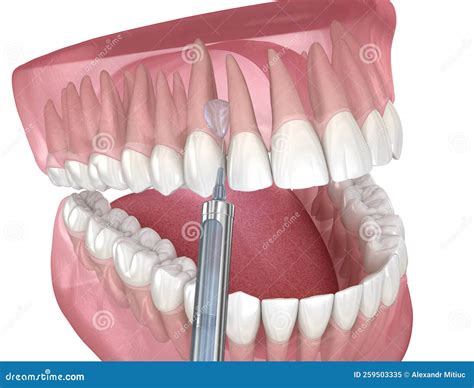Local Anesthesia In Dentistry Ppt At David Luft Blog