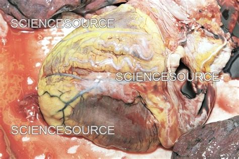 Heart Post Mortem Gross Specimen Stock Image Science Source Images