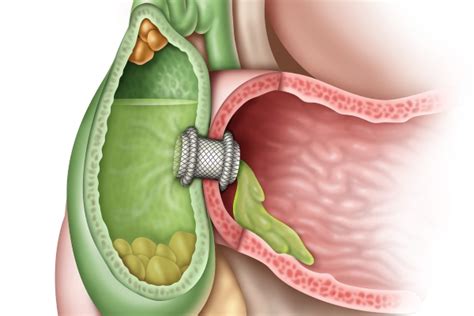 Gallbladder Drainage Without A Drain Introducing The Axios™ Stent Gallbladder Drainage Without A Drain Introducing The Axios™ Stent