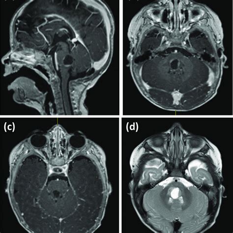 Pre Operative Mri Imaging A Sagittal T1 Post Gadolinium Peripheral