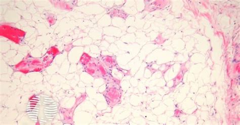 Angiolipoma Pathology Image