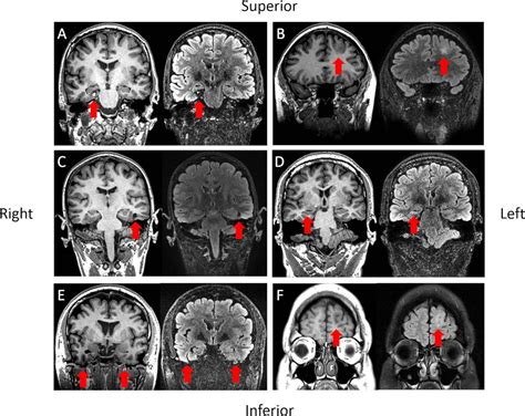 Eeg Of Normal Brain Vs Epilepsy Retcool