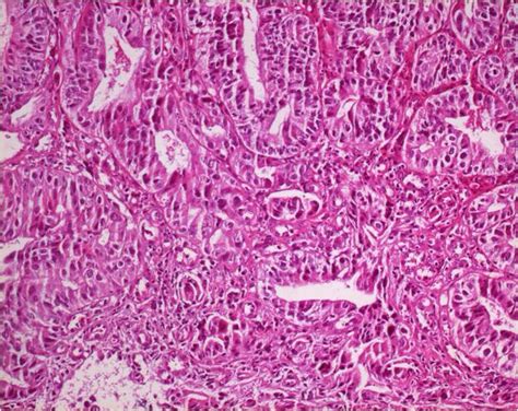 Adenocarcinoma Moderately Differentiated Intestinal Component Lauren Download Scientific