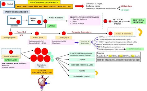 Leucemia LinfoblÁstica De CÉlulas B Precursoras Ll B Jose Javier Udocz