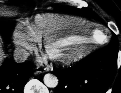 Left Ventricle Diverticulum Lv The Common Vein