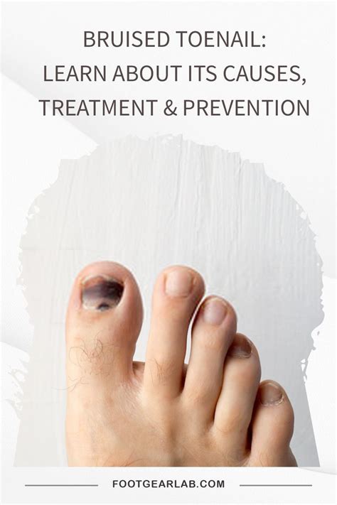 Bruised Toenail Learn About Its Causes Treatment And Prevention Artofit