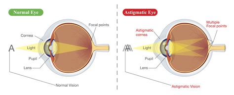 I Have Astigmatism So Does That Mean Im Not Suitable For Laser Eye
