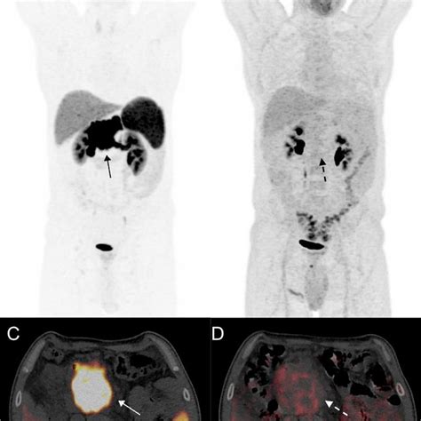 Typical Example Of Flip Flop Effect On Metabolic Imaging In A Download Scientific Diagram