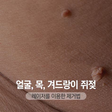 겨드랑이 쥐젖 제거 어렵지 않아요 네이버 블로그