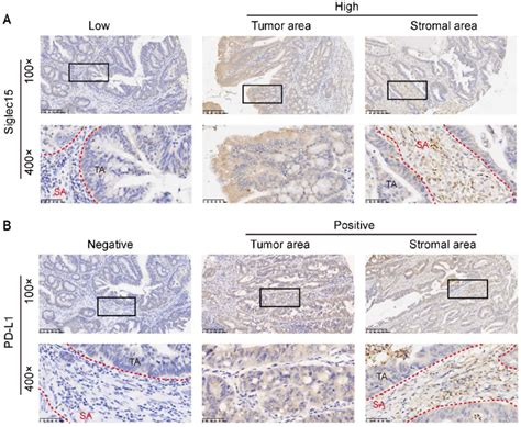 Siglec15 And Pd L1 Expression In Coad Cancer Samples Representative