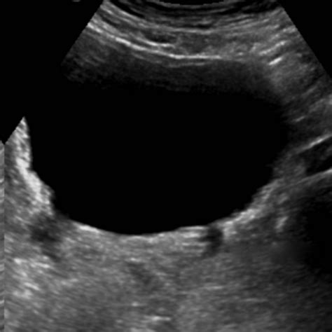 Bladder Diverticulum Ultrasound