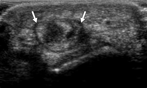 Foreign Body Ultrasound