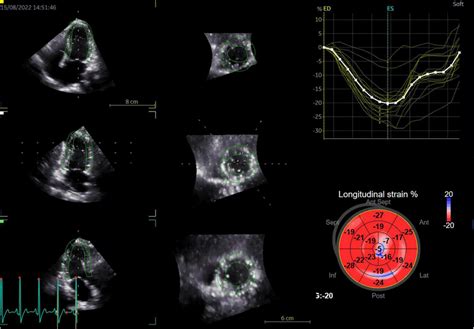Representative Diagram Of Three Dimensional Speckle Tracking Strain