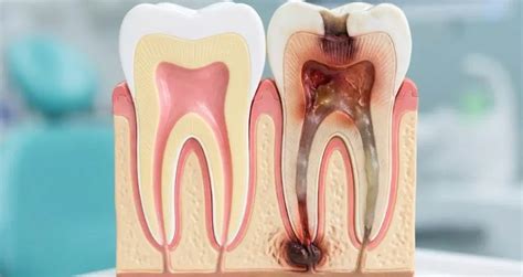Signs Of An Infected Root Canal Saving Your Natural Tooth Lema