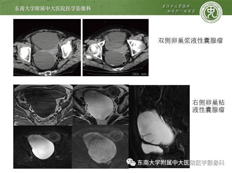 【病例】卵巢囊肿蒂扭转1例mr影像 影像ppt
