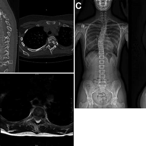 Case 4 Neuroimaging Demonstrating Collapse Of The T4 Vertebral Body Download Scientific