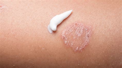 What Is Cellulitis The Dangers Signs And Symptoms To Watch Out For 1md Nutrition™