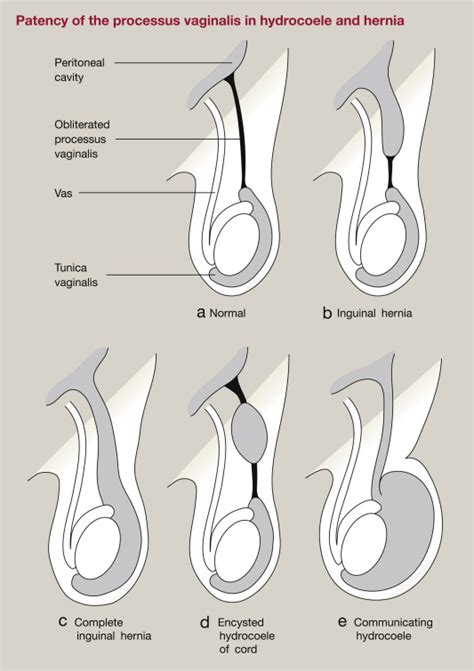 Congenital Inguinal Hernia Hydrocoele And Undescended Testis Surgery