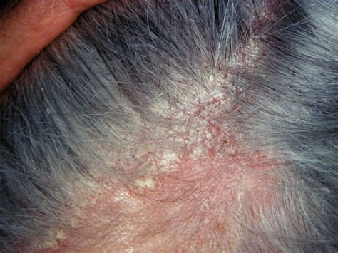 Dermatitis Seboroik Penyebab Gejala Dan Pengobatan