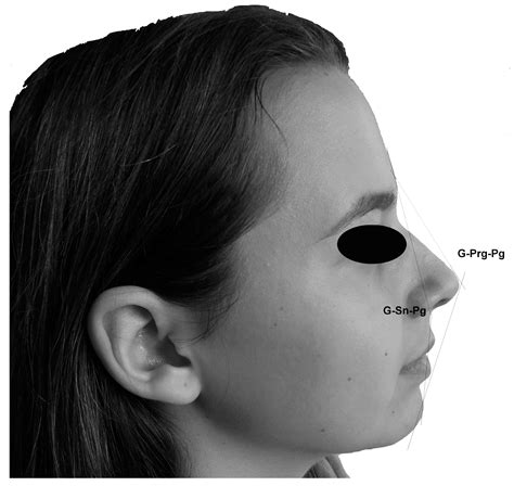 Differences In Angular Photogrammetric Soft Tissue Facial