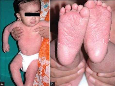 Epidermolytic Ichthyosis Epidermolytic Hyperkeratosis Treatment