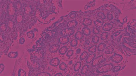 Ulcerative Colitis Learning Zone Medthority