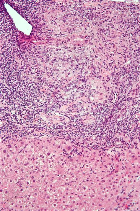 Primary Biliary Cholangitis USMLE Strike
