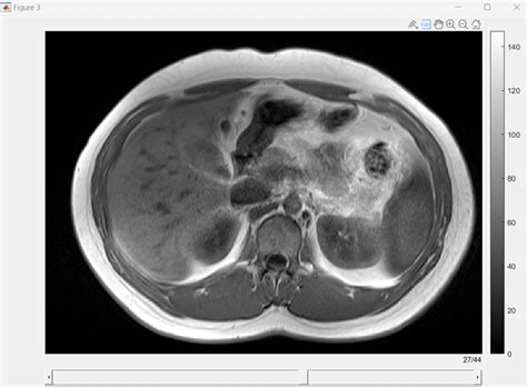 A 3d Quantification Technique For Liver Fat Fraction Distribution Analysis Using Dixon Magnetic