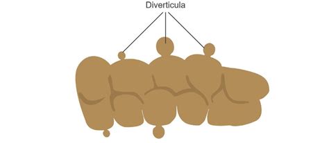 Abdominal Ct Diverticulitis • Litfl • Radiology Library