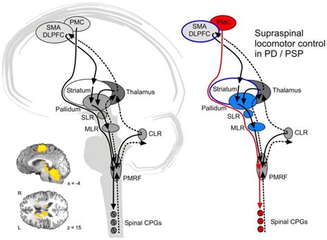 Imaging What Can It Tell Us About Parkinsonian Gait Pmc