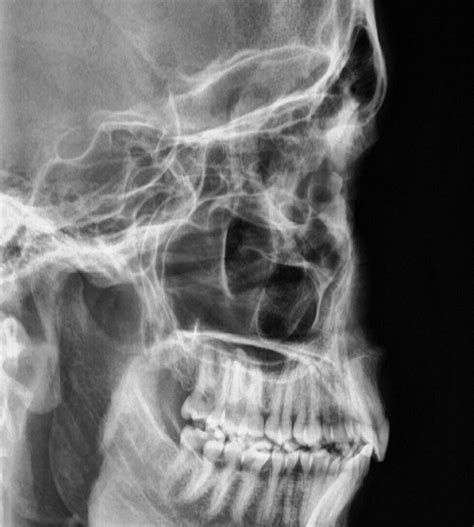Sinus Buyxraysonline