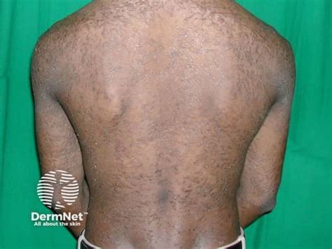 Erythrokeratodermia Variabilis Erythrokeratoderma Variabilis In A