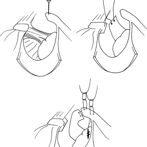 Clinical Presentation Of A Type V Acromioclavicular Separation Note Download Scientific
